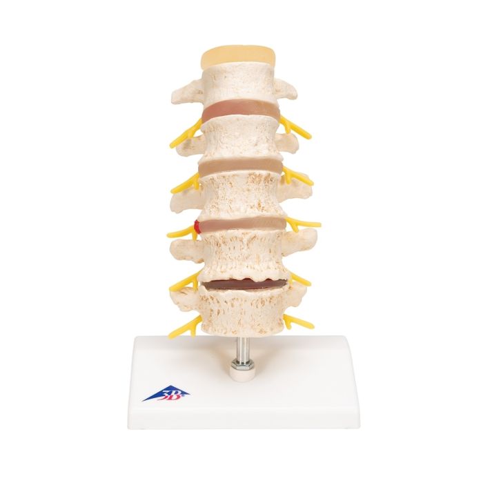 Spine Degeneration Model Pack of 1 | AHP Medicals