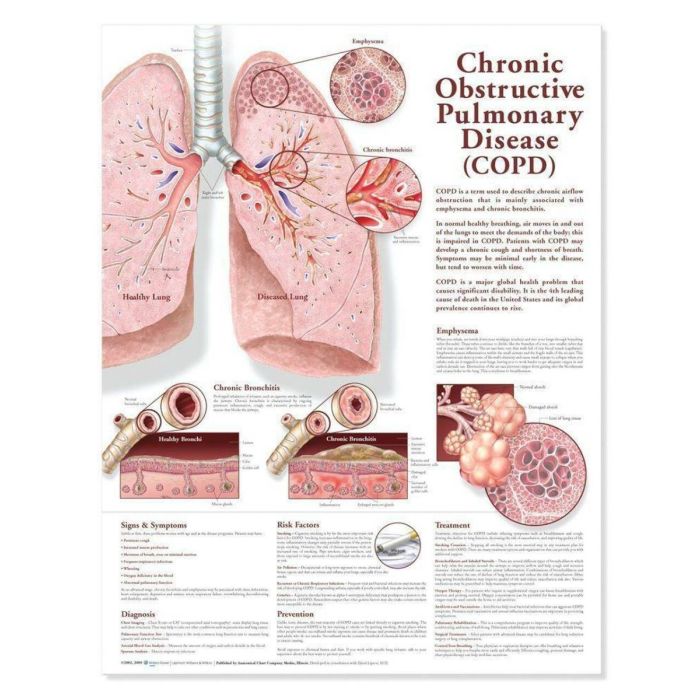 Anatomical Chart - Chronic Obstructive Pulmonary Disease (COPD), 2nd ...