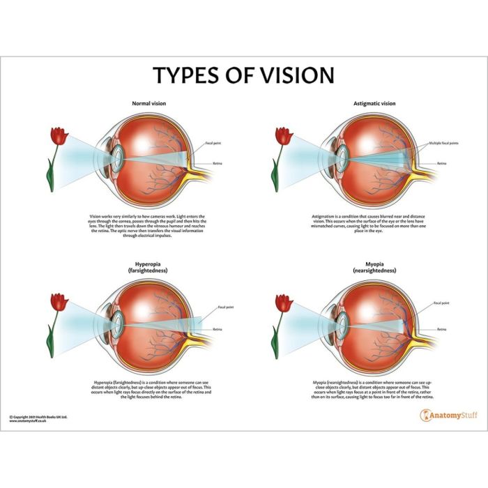Types of Vision Chart / Poster - Laminated Pack of 1 | AHP Medicals